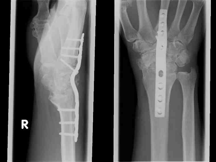 Arthrodesis – rogismycopilot